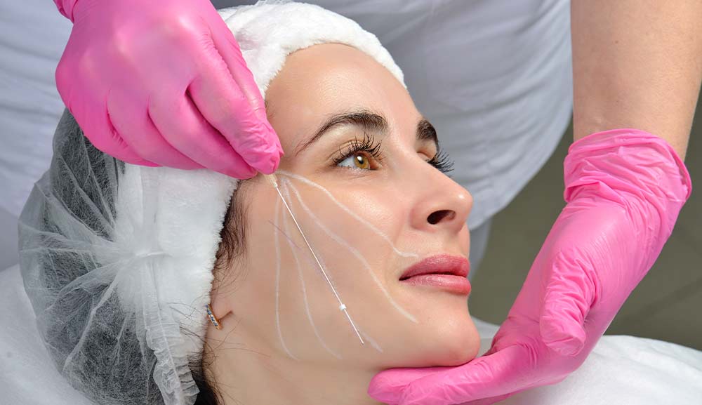 Thread Lift - Dr. Rana Gheith